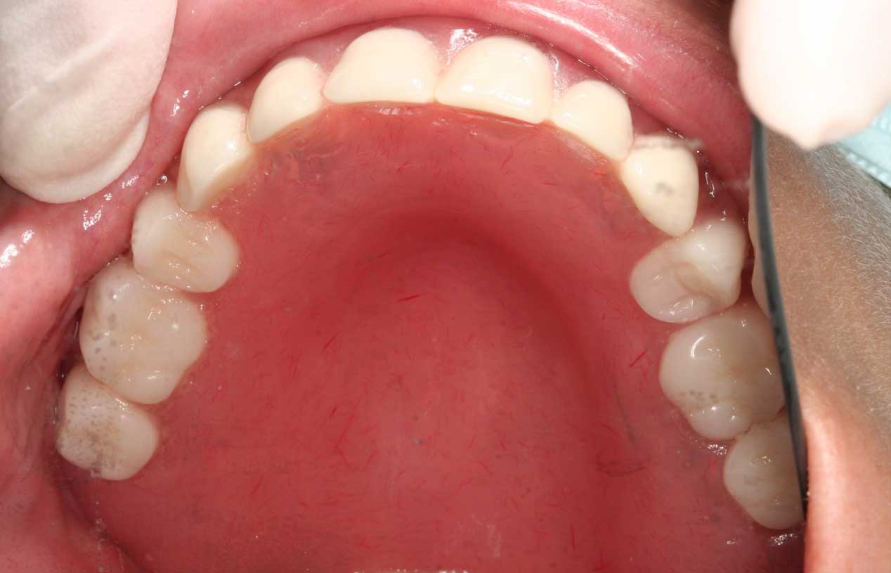 The Average Cost Of Root Canal And Crown In Los Angeles The Average Cost Of Root Canal And Crown In Los Angeles