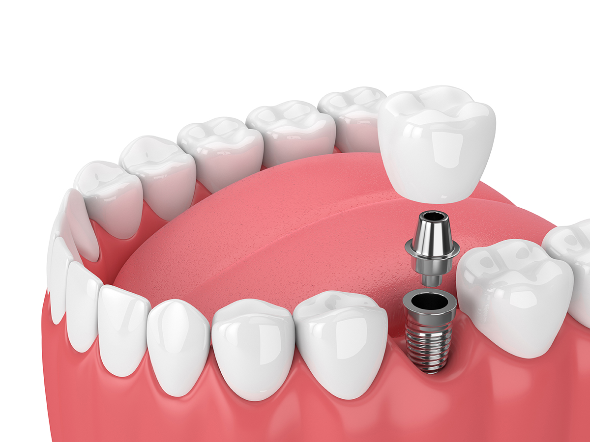 Biocompatible Materials in Dental Implants: Why It Matters - Holistic ...